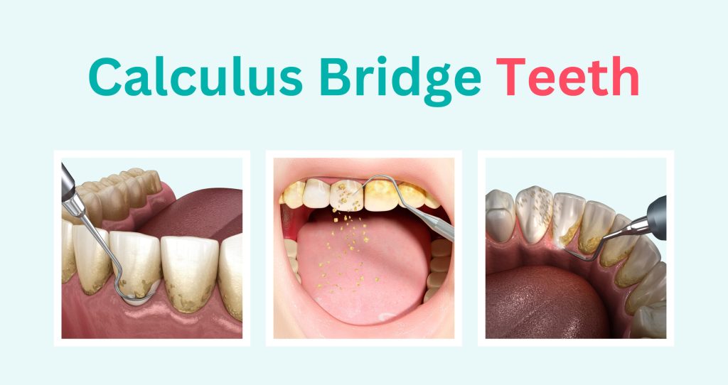 Dental Calculus Bridge